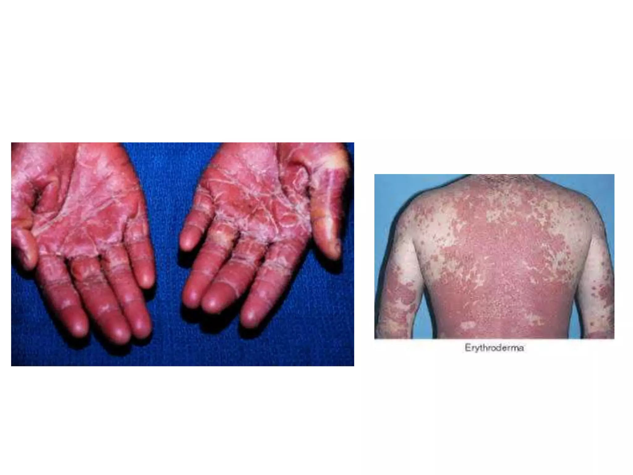 Paraneoplastic syndromes - CNS manifestations | PPTX