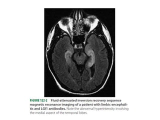 Paraneoplastic syndromes - CNS manifestations | PPTX