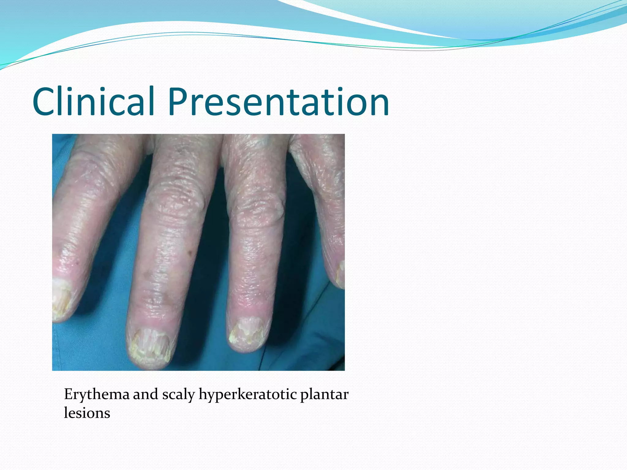 Paraneoplastic syndromes presentation | PPTX