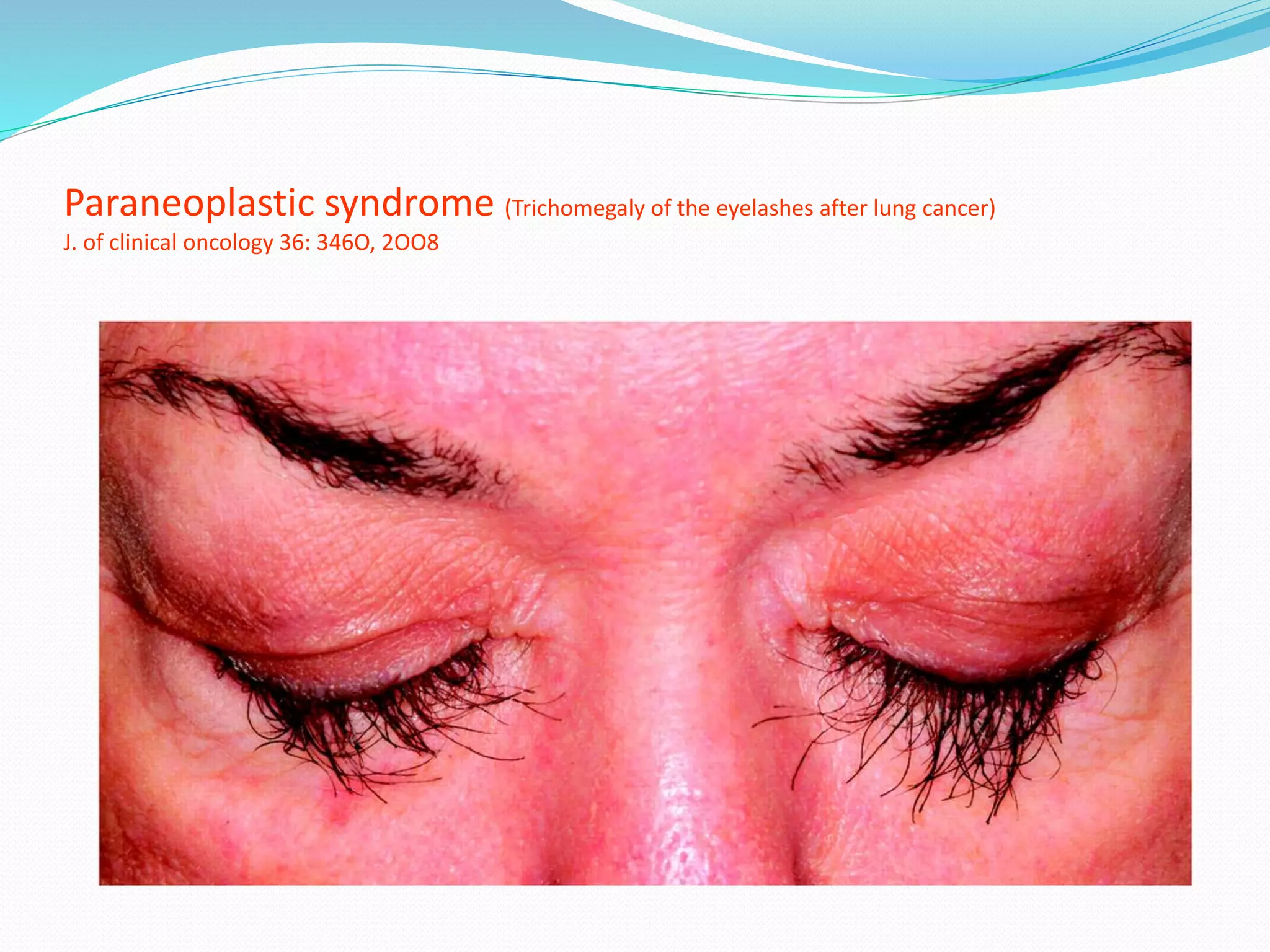 Paraneoplastic syndromes presentation | PPTX