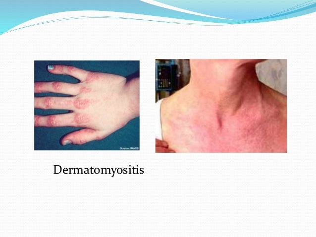 Paraneoplastic syndromes presentation