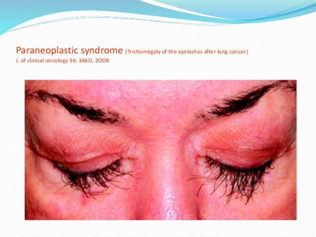 Paraneoplastic syndromes presentation
