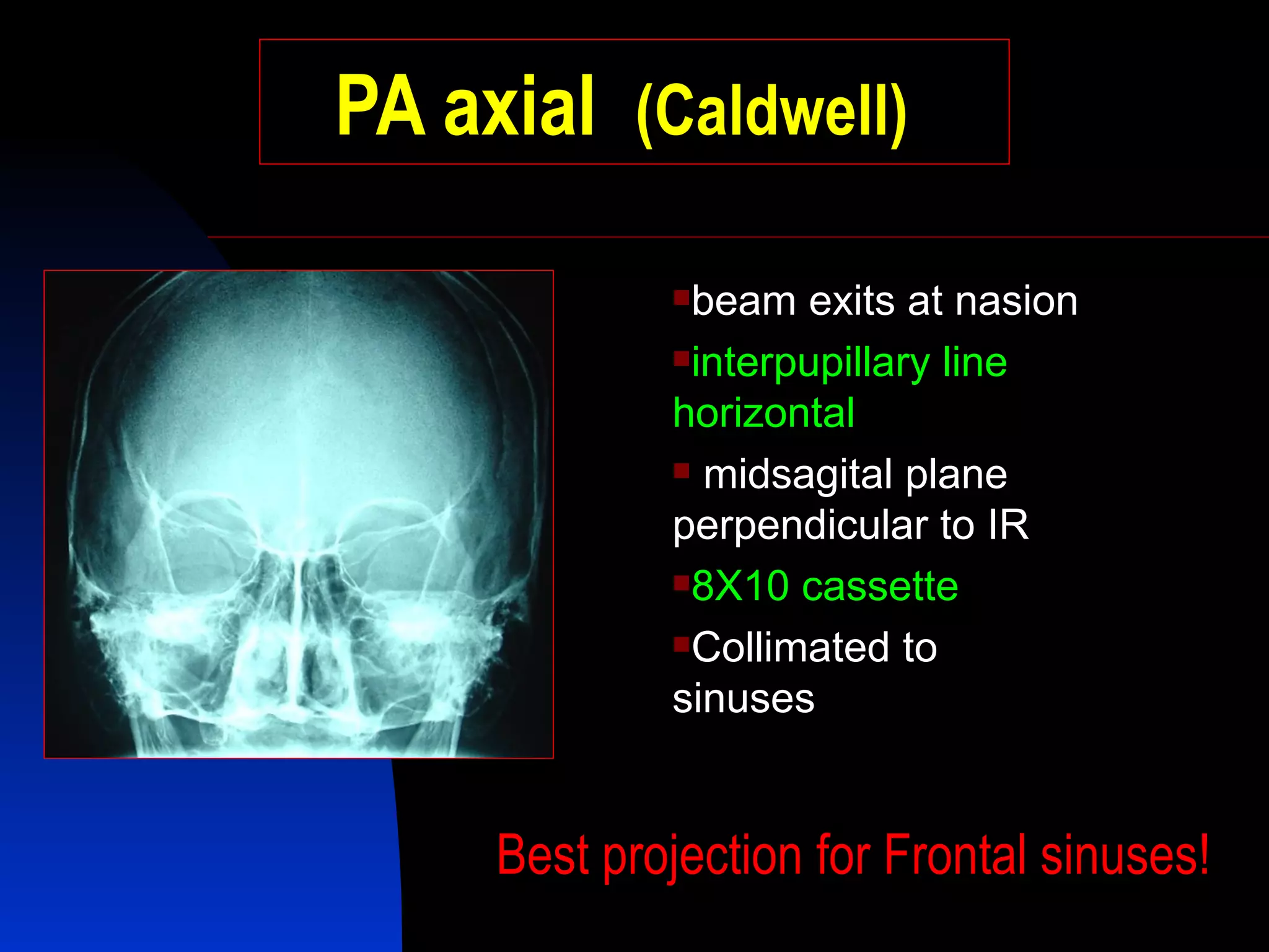 Paransasal Sinuses Home Edition | PPT