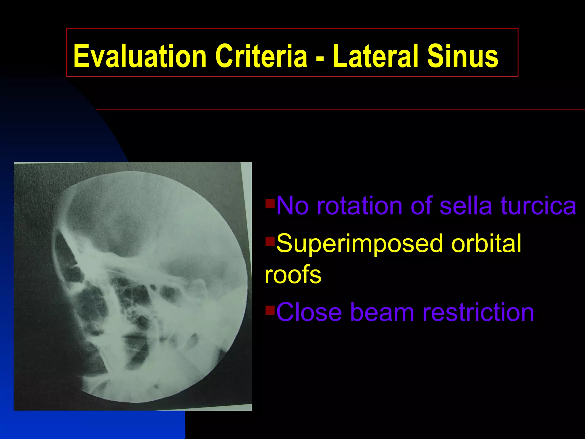 Paransasal Sinuses Home Edition | PPT