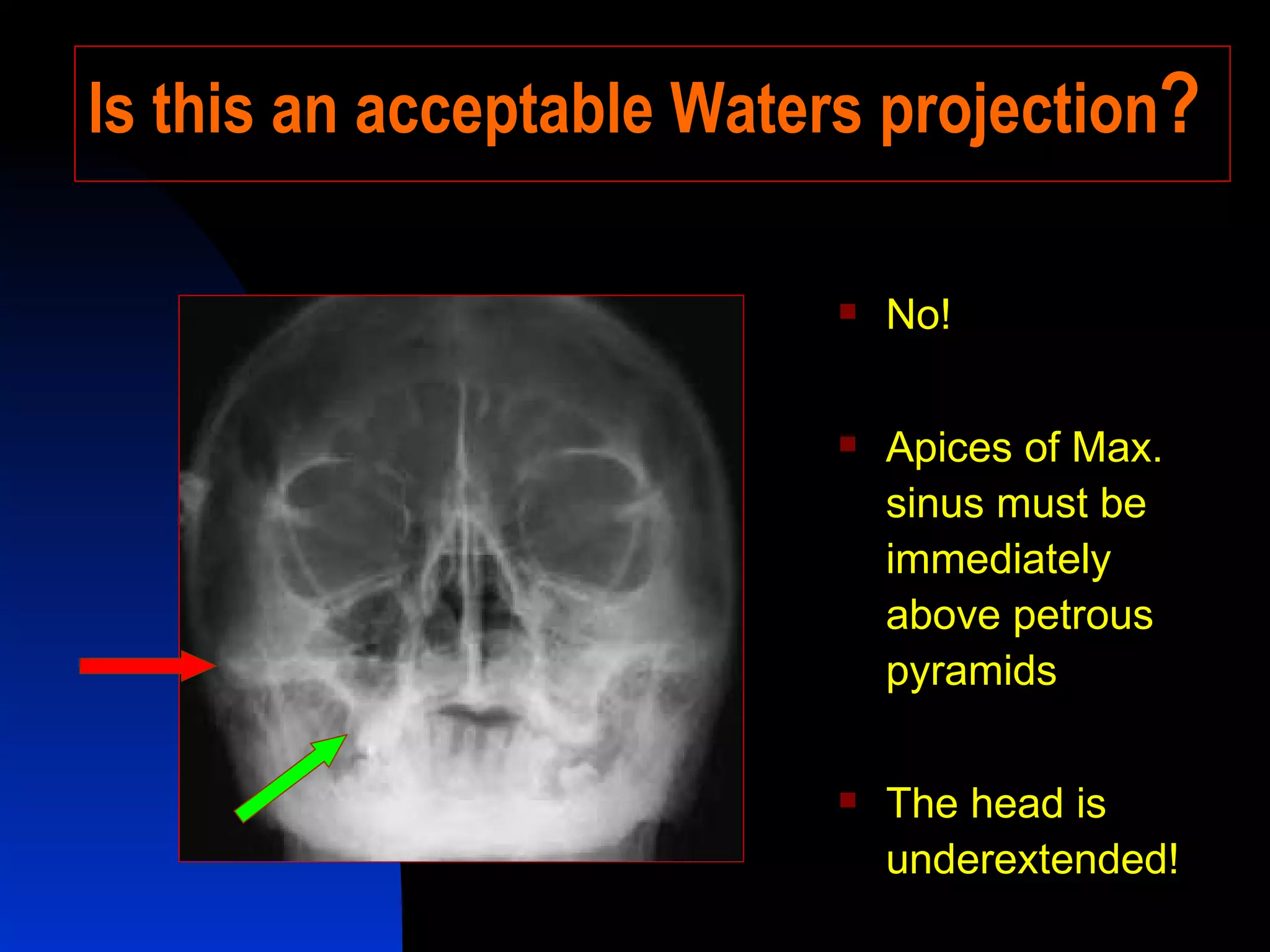 Paransasal Sinuses Home Edition | PPT