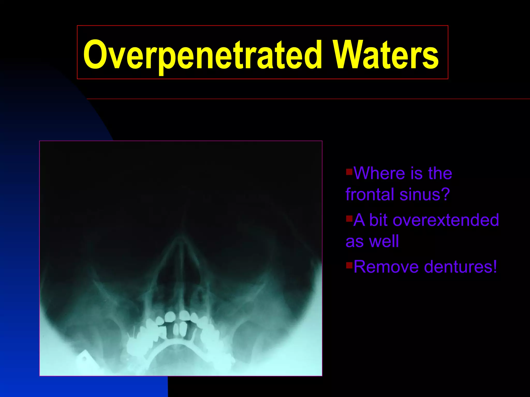 Paransasal Sinuses Home Edition | PPT
