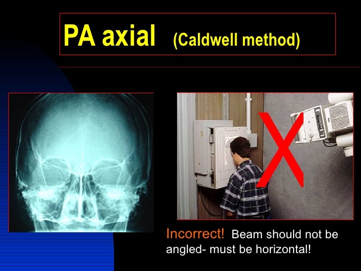 Paransasal Sinuses Home Edition