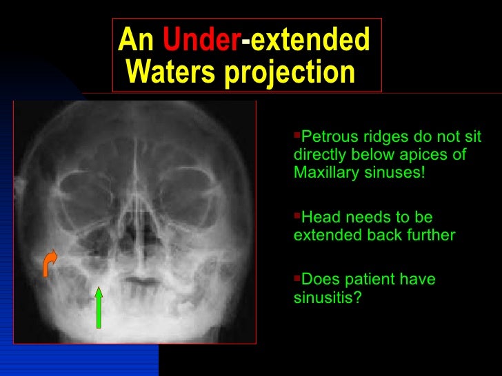 Paransasal Sinuses Home Edition