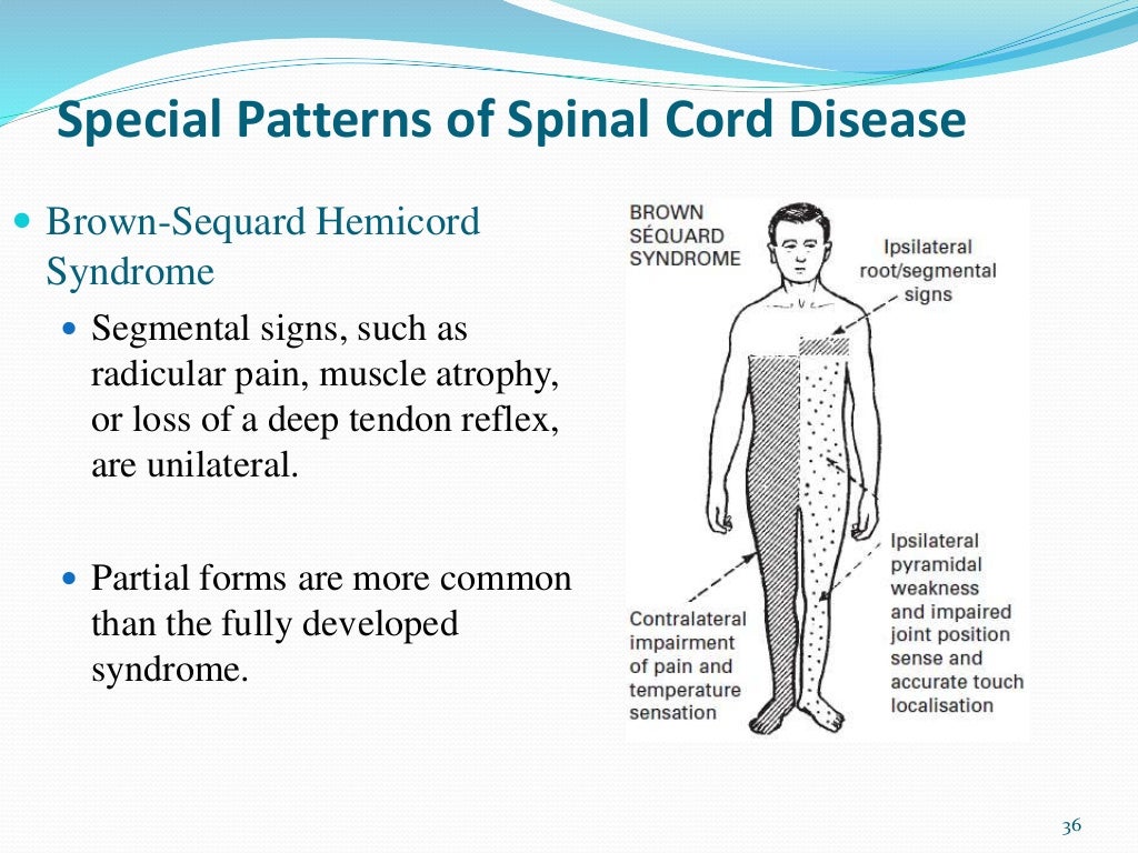 Paraparesis biplave nams