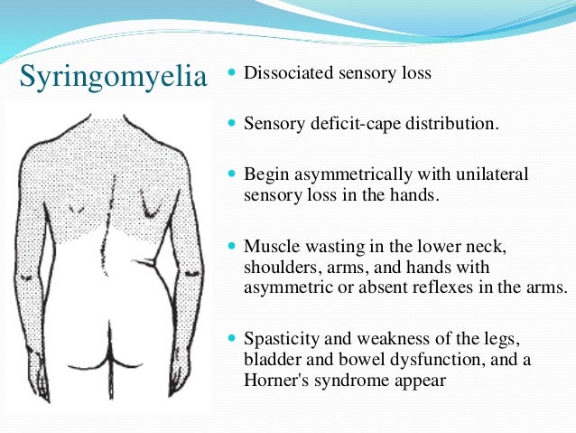 Paraparesis biplave nams