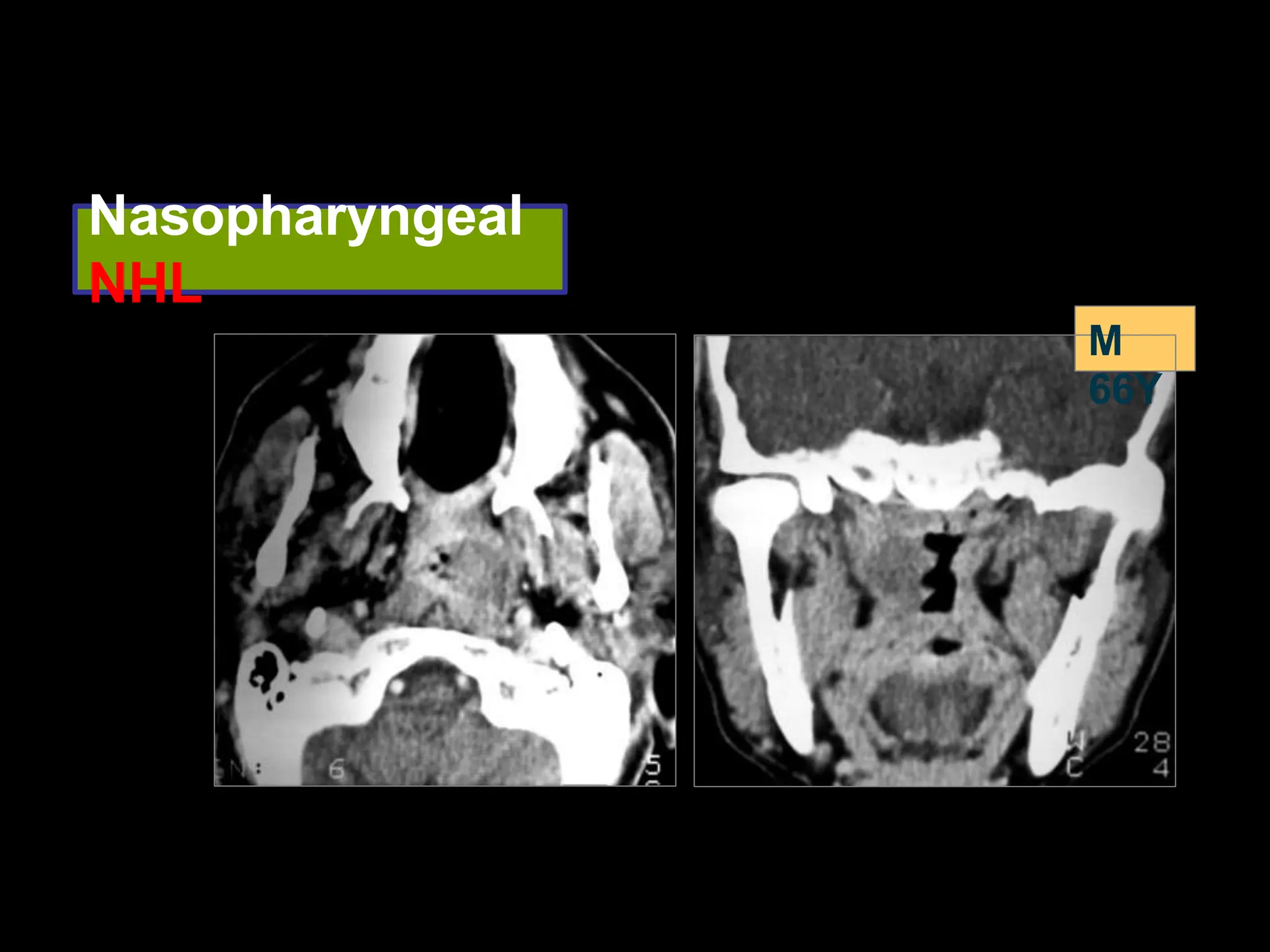 ALL ABOUT DETALED DESCRIPTION Parapharyngeal-spaces.pptx