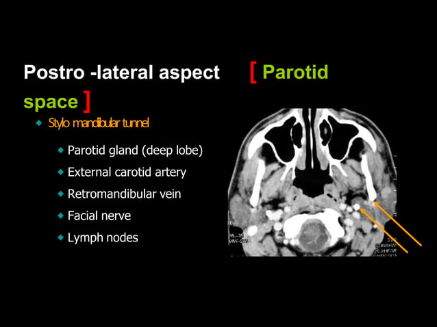 ALL ABOUT DETALED DESCRIPTION Parapharyngeal-spaces.pptx