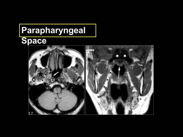 ALL ABOUT DETALED DESCRIPTION Parapharyngeal-spaces.pptx