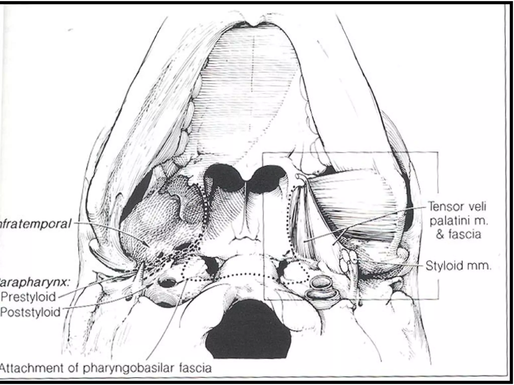 Parapharyngeal space tumours | PPT