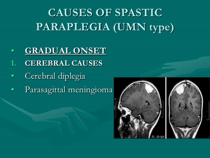 Paraplegia Causes