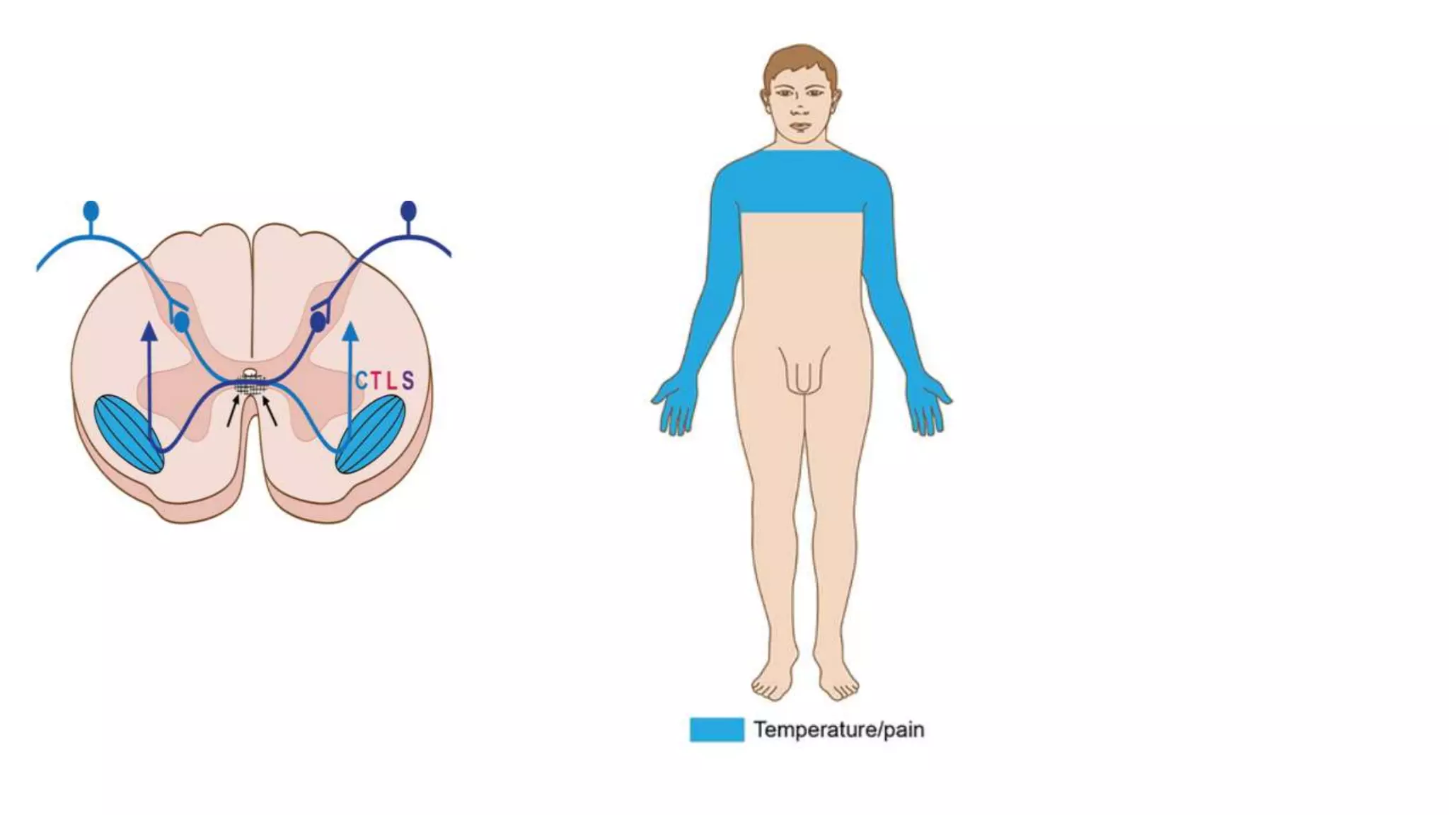 Paraplegia And Spinal Cord Syndromes Ppt
