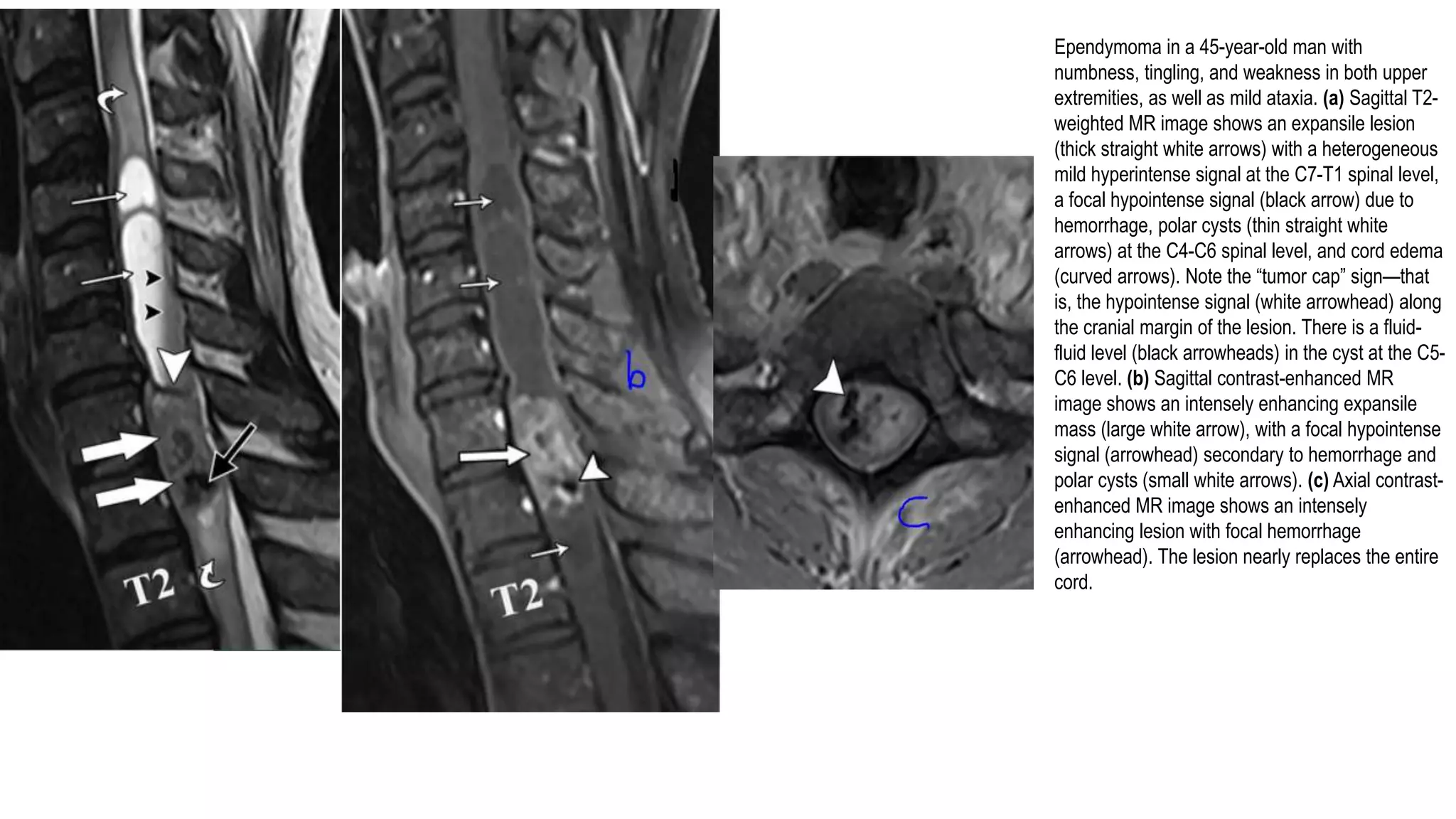 Paraplegia And Spinal Cord Syndromes Ppt