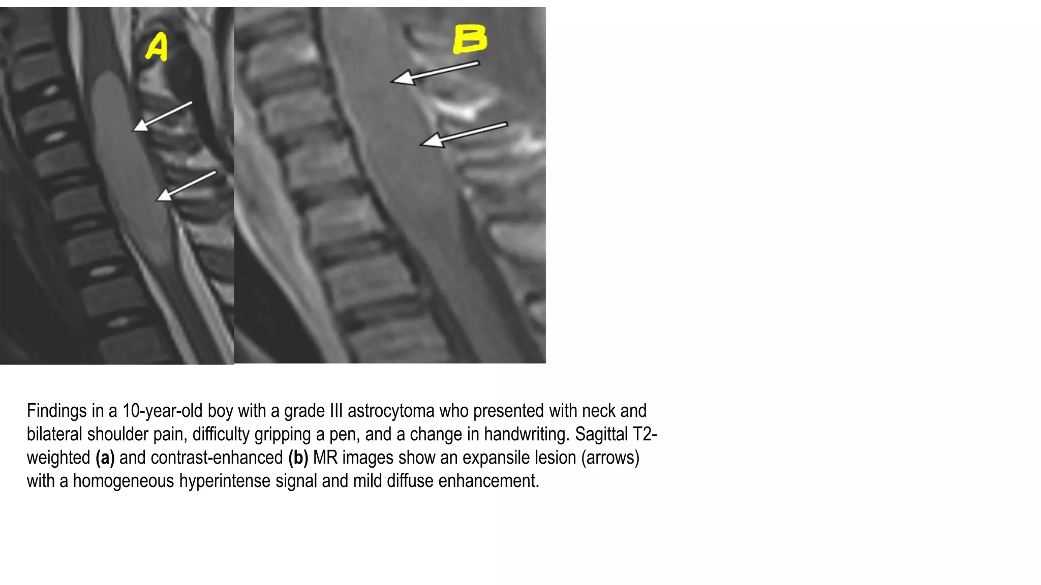Paraplegia And Spinal Cord Syndromes Ppt