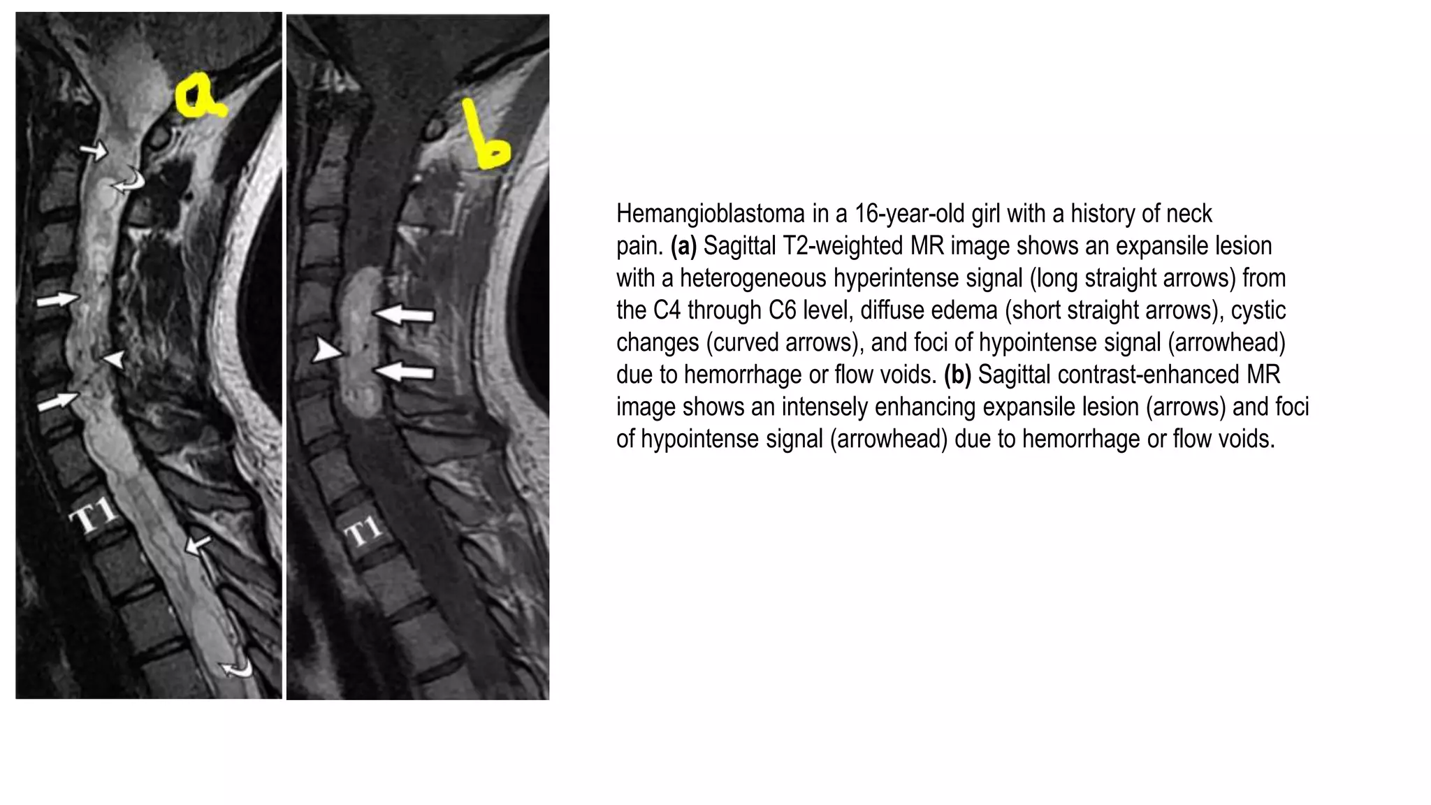 Paraplegia And Spinal Cord Syndromes Ppt
