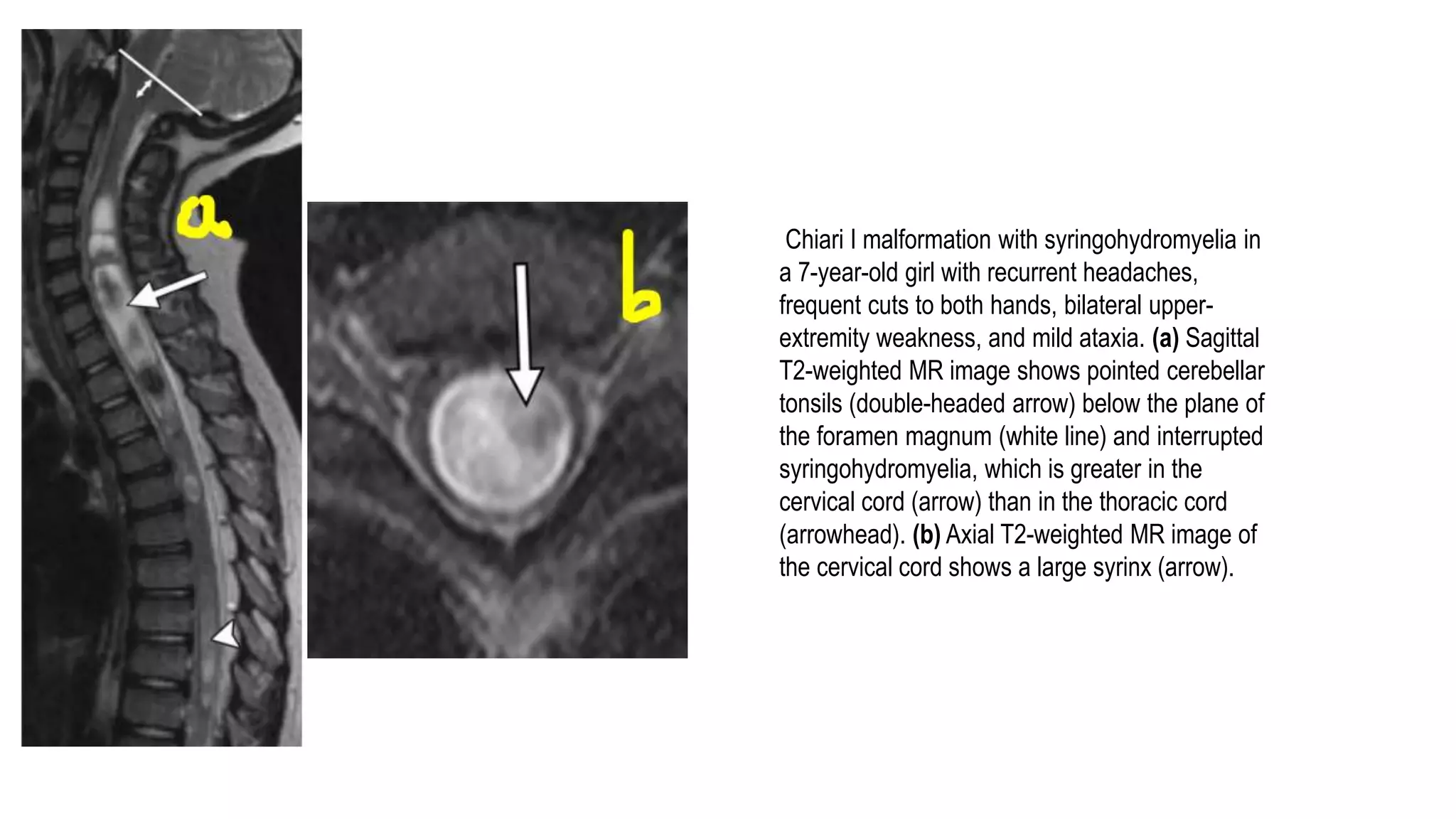 Paraplegia And Spinal Cord Syndromes Ppt