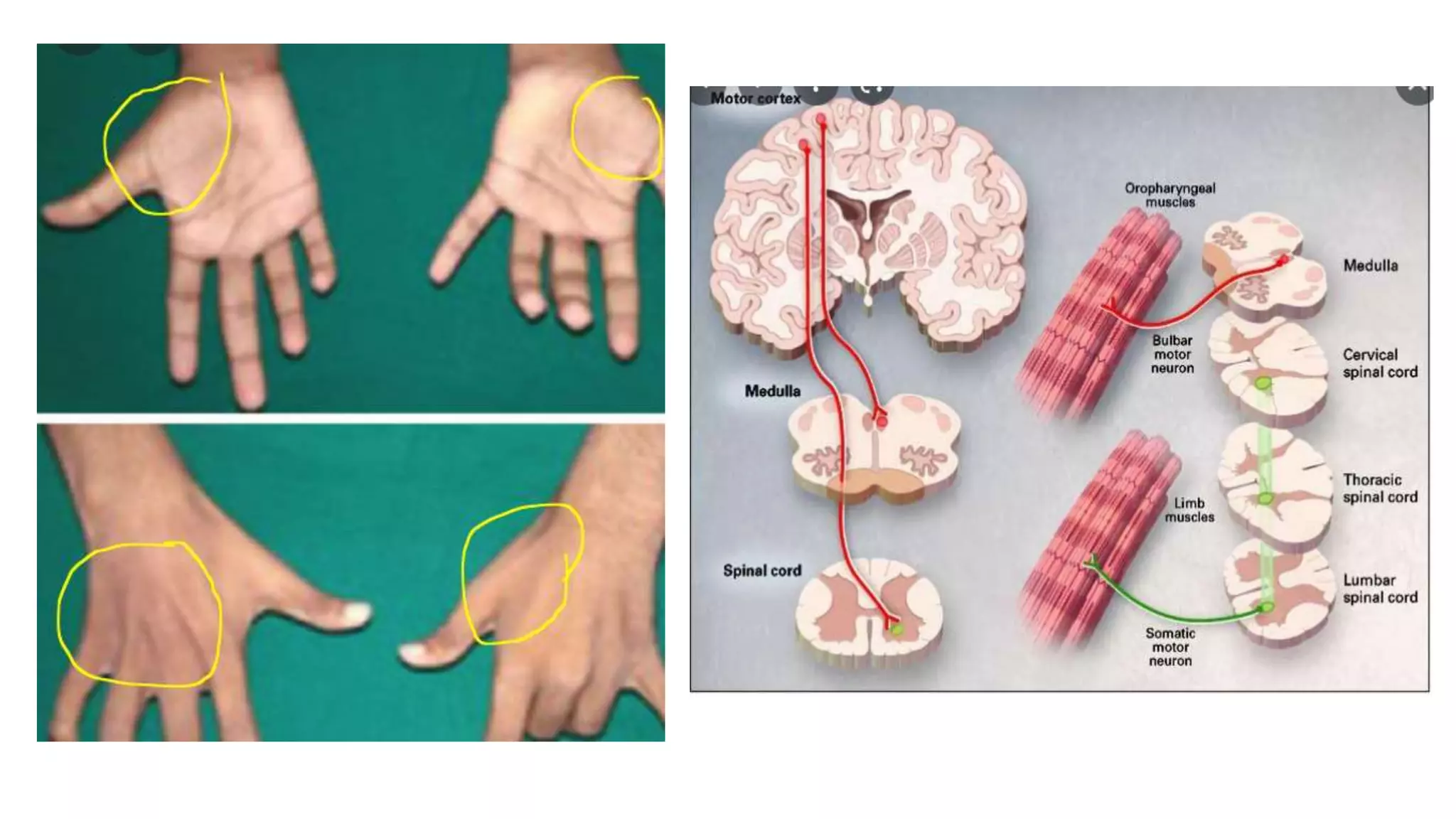 Paraplegia And Spinal Cord Syndromes Ppt