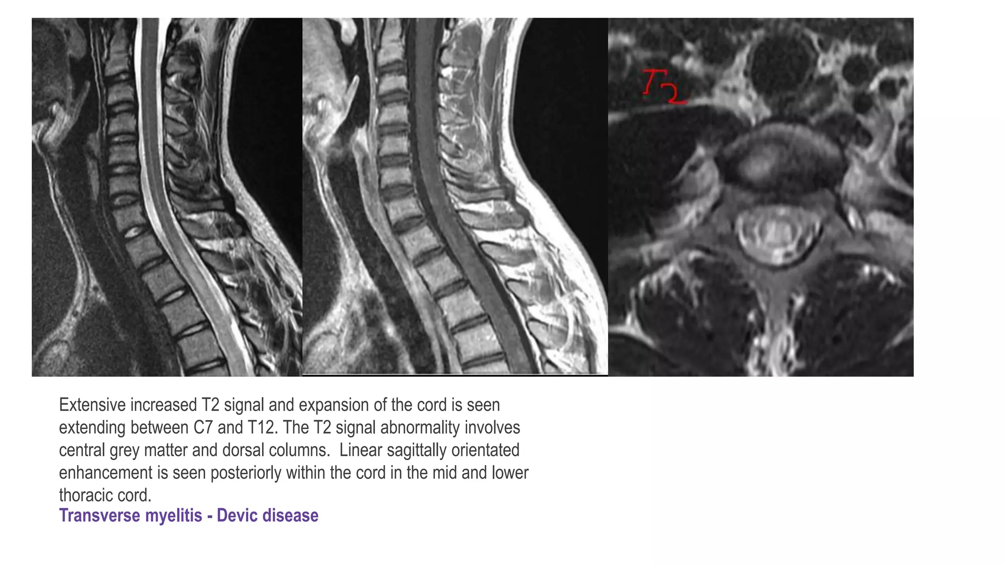 Paraplegia and spinal cord syndromes | PPTX