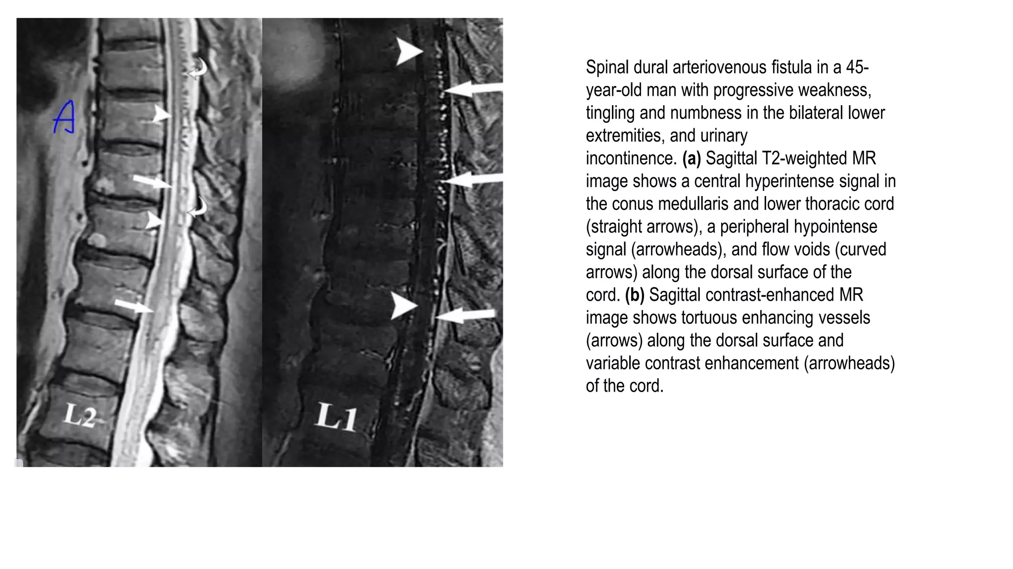Paraplegia And Spinal Cord Syndromes Ppt
