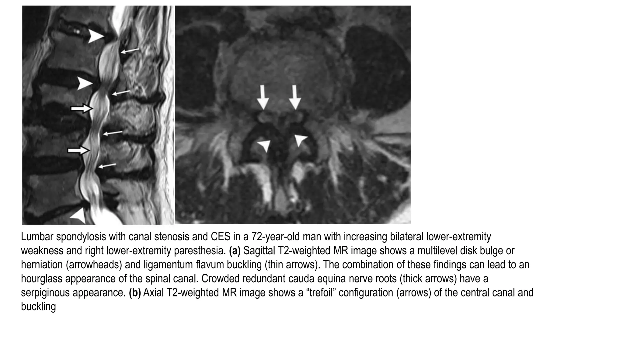 Paraplegia and spinal cord syndromes | PPTX