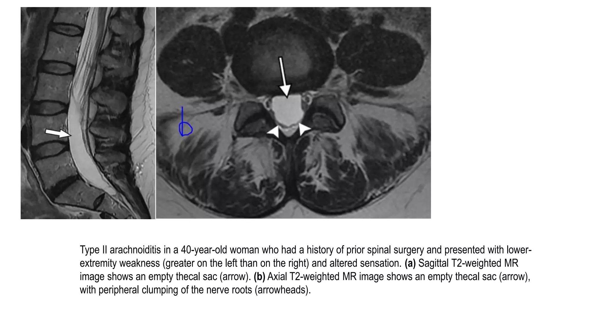 Paraplegia and spinal cord syndromes | PPTX