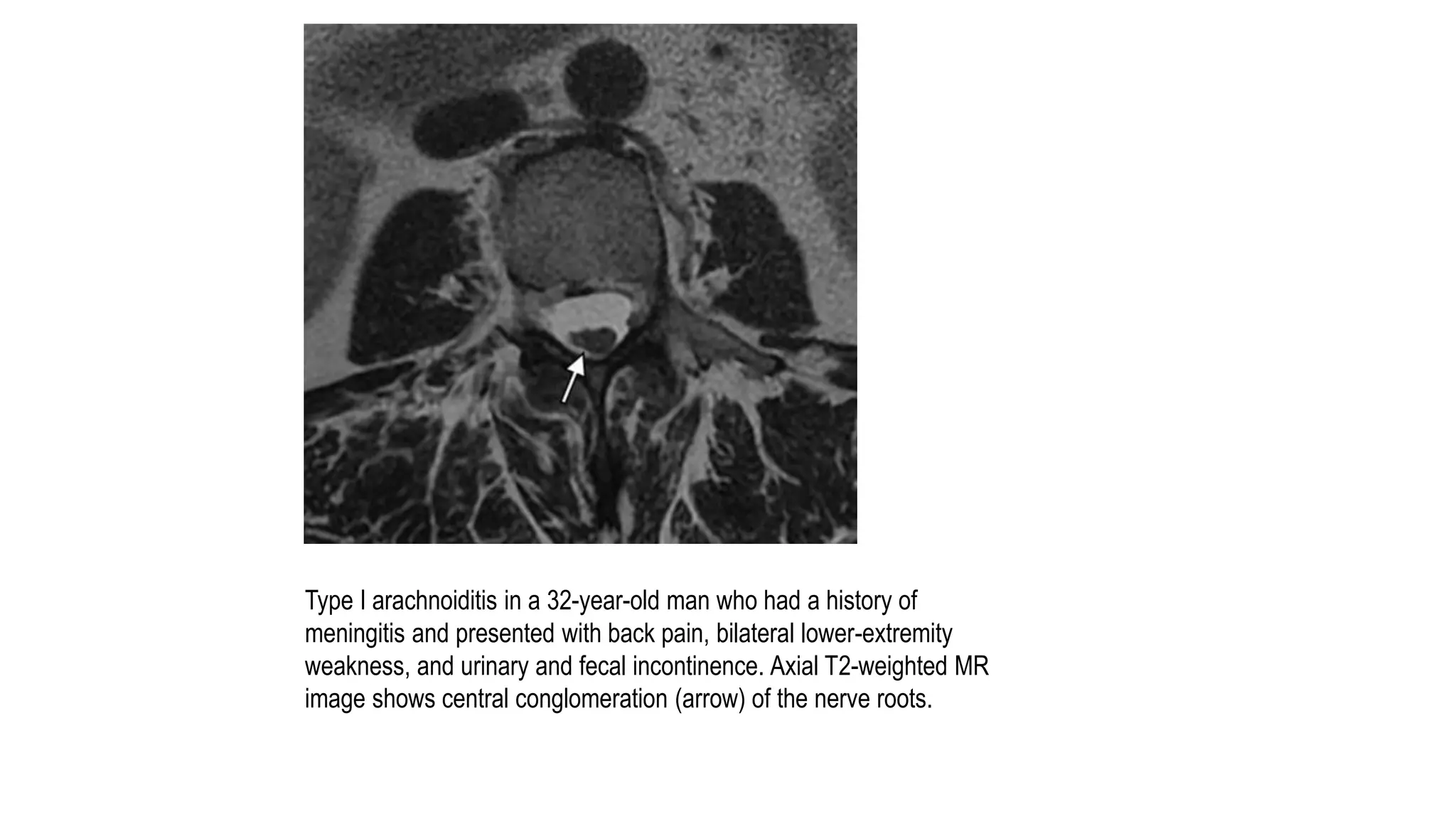 Paraplegia and spinal cord syndromes | PPTX