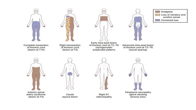 Paraplegia And Spinal Cord Syndromes Ppt