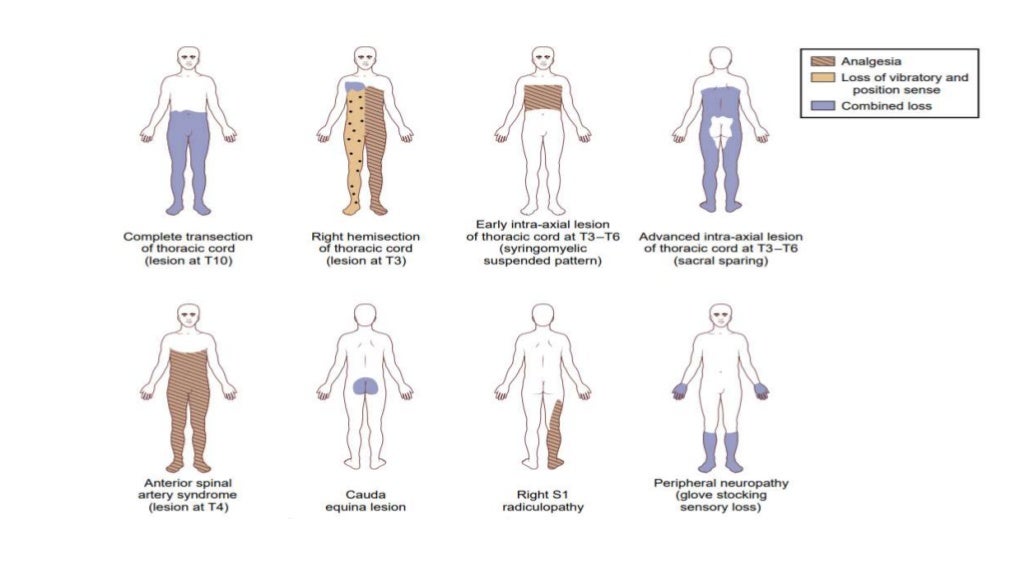 Paraplegia and spinal cord syndromes