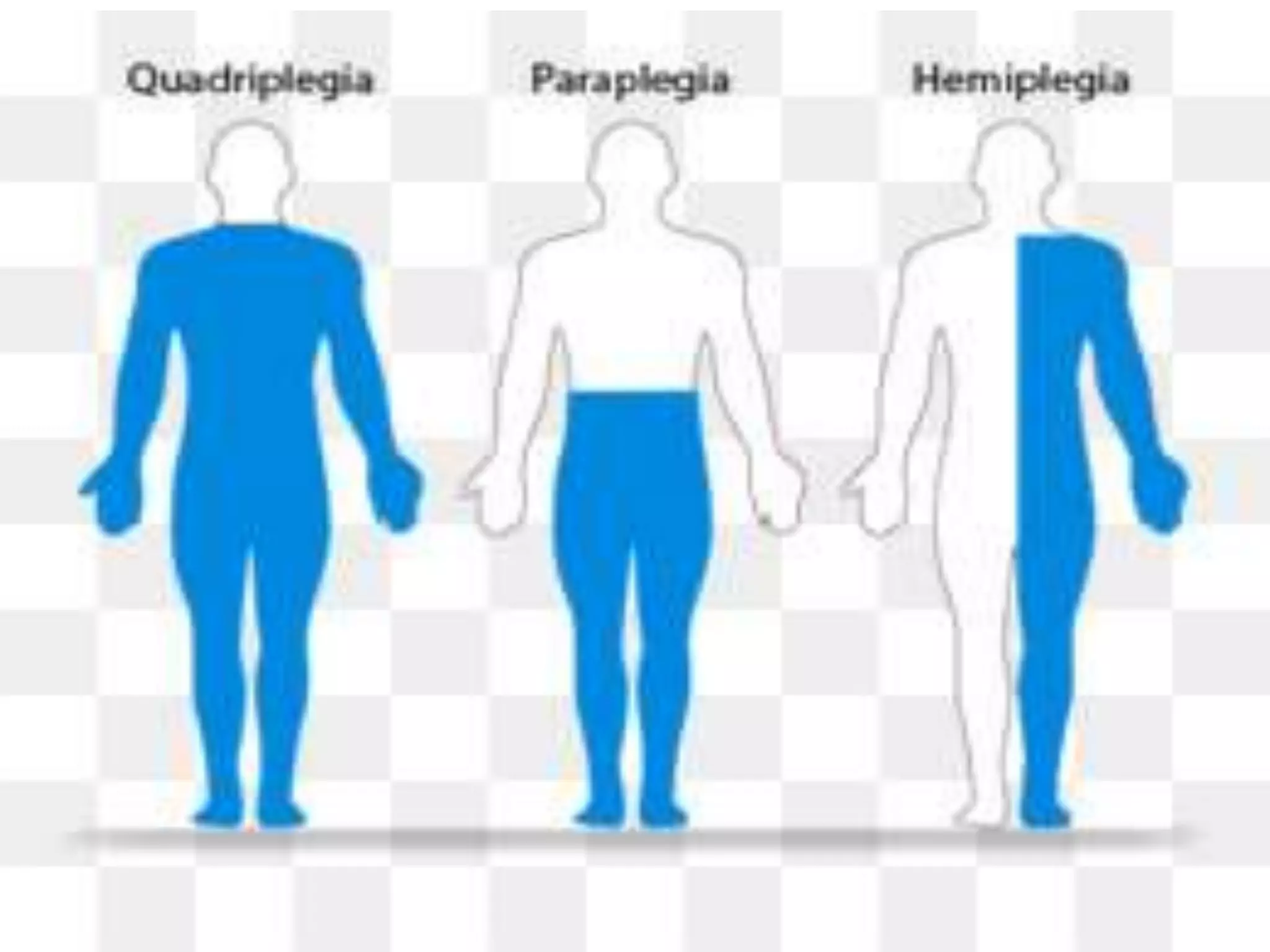 Paraplegia ppt | PPTX