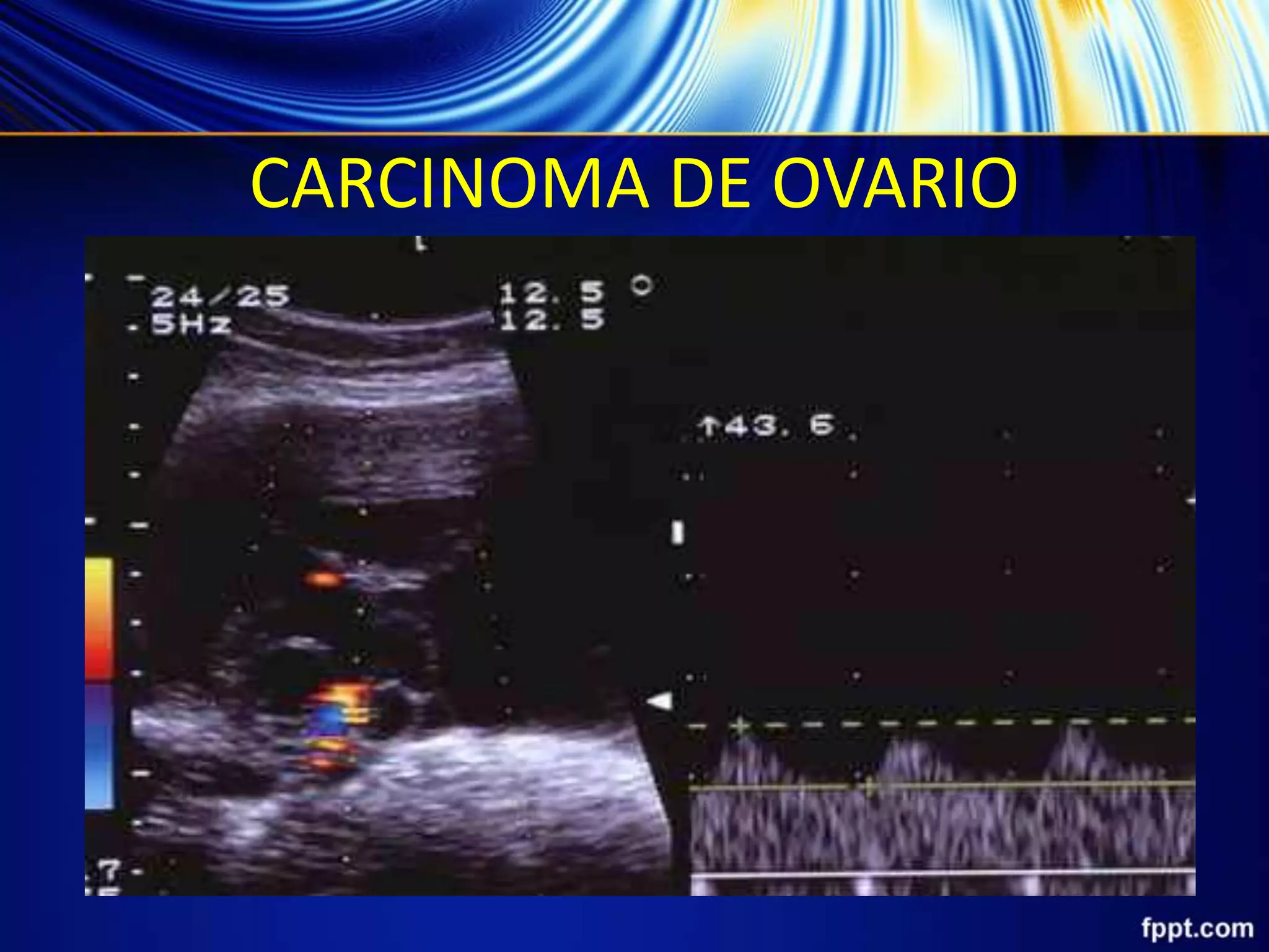 Cáncer de Ovario y Patología de Salpinge | PPT