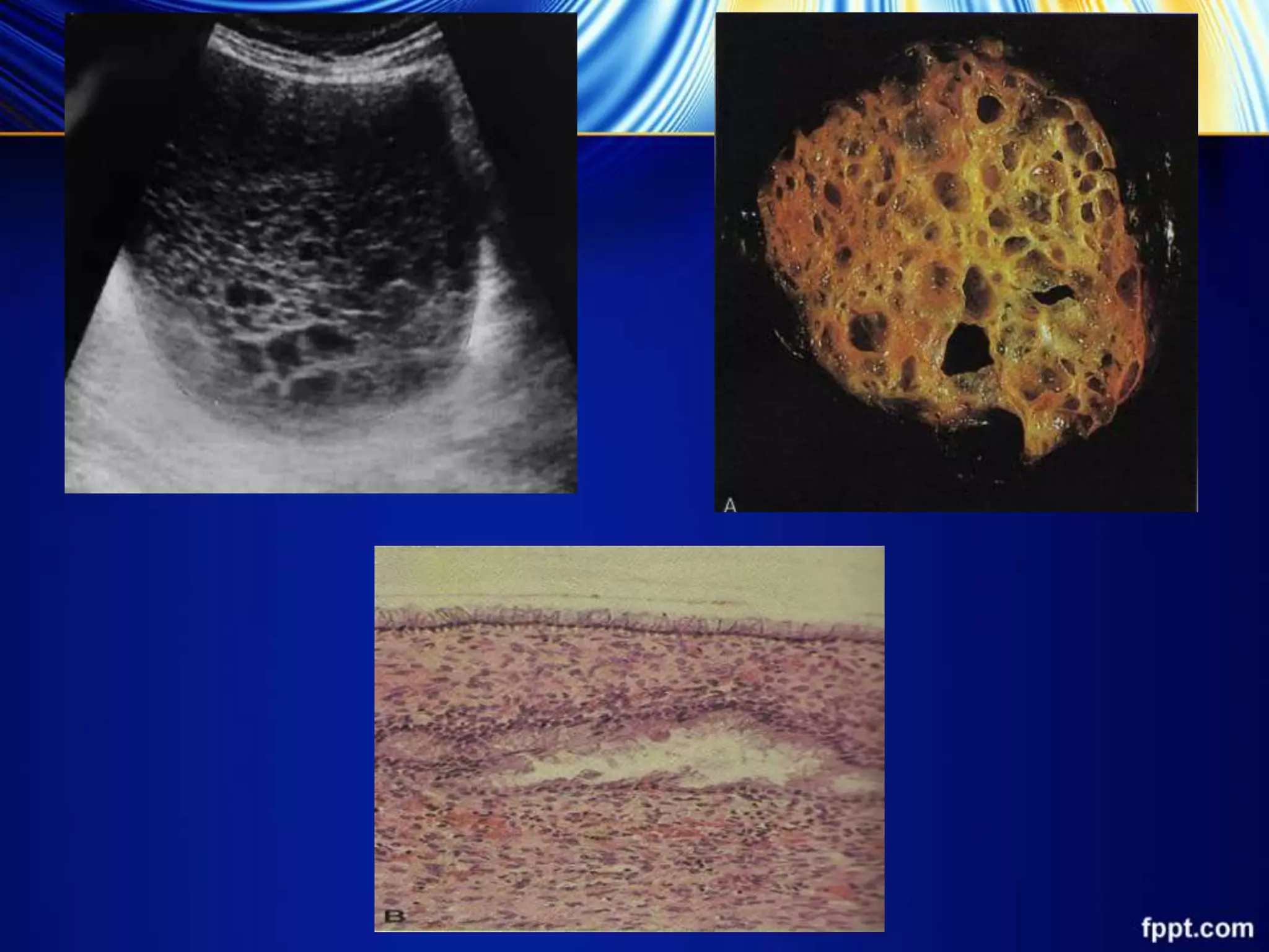Cáncer de Ovario y Patología de Salpinge | PPT