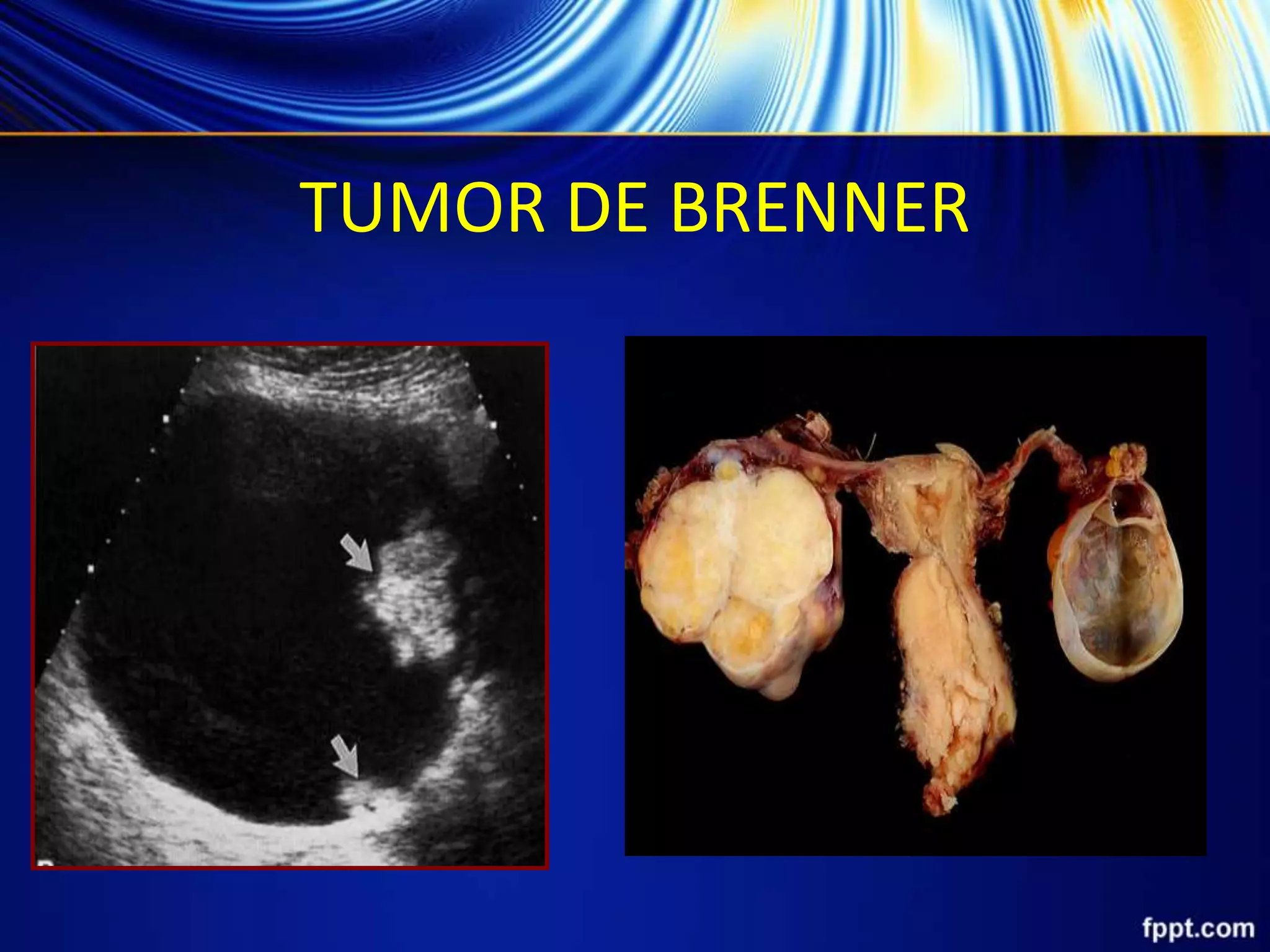 Cáncer de Ovario y Patología de Salpinge | PPT