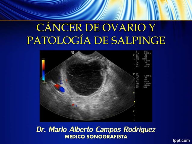 Cáncer de Ovario y Patología de Salpinge | PPT