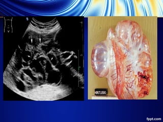 Cáncer de Ovario y Patología de Salpinge | PPTX