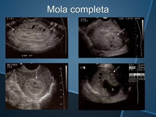 Neoplasia Trofoblástica Gestacional | PPTX