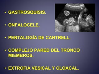 Ultrasonido Extrofia Vesical