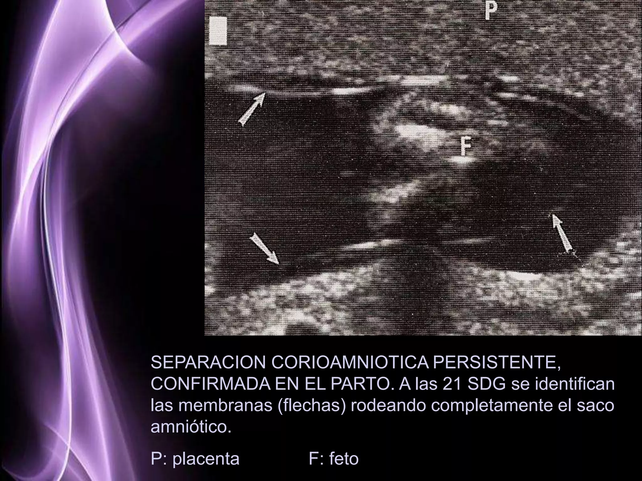 ECOGRAFÍA NORMAL Y PATOLOGÍA DE LA PLACENTA Y CORDÓN UMBILICAL | PPTX