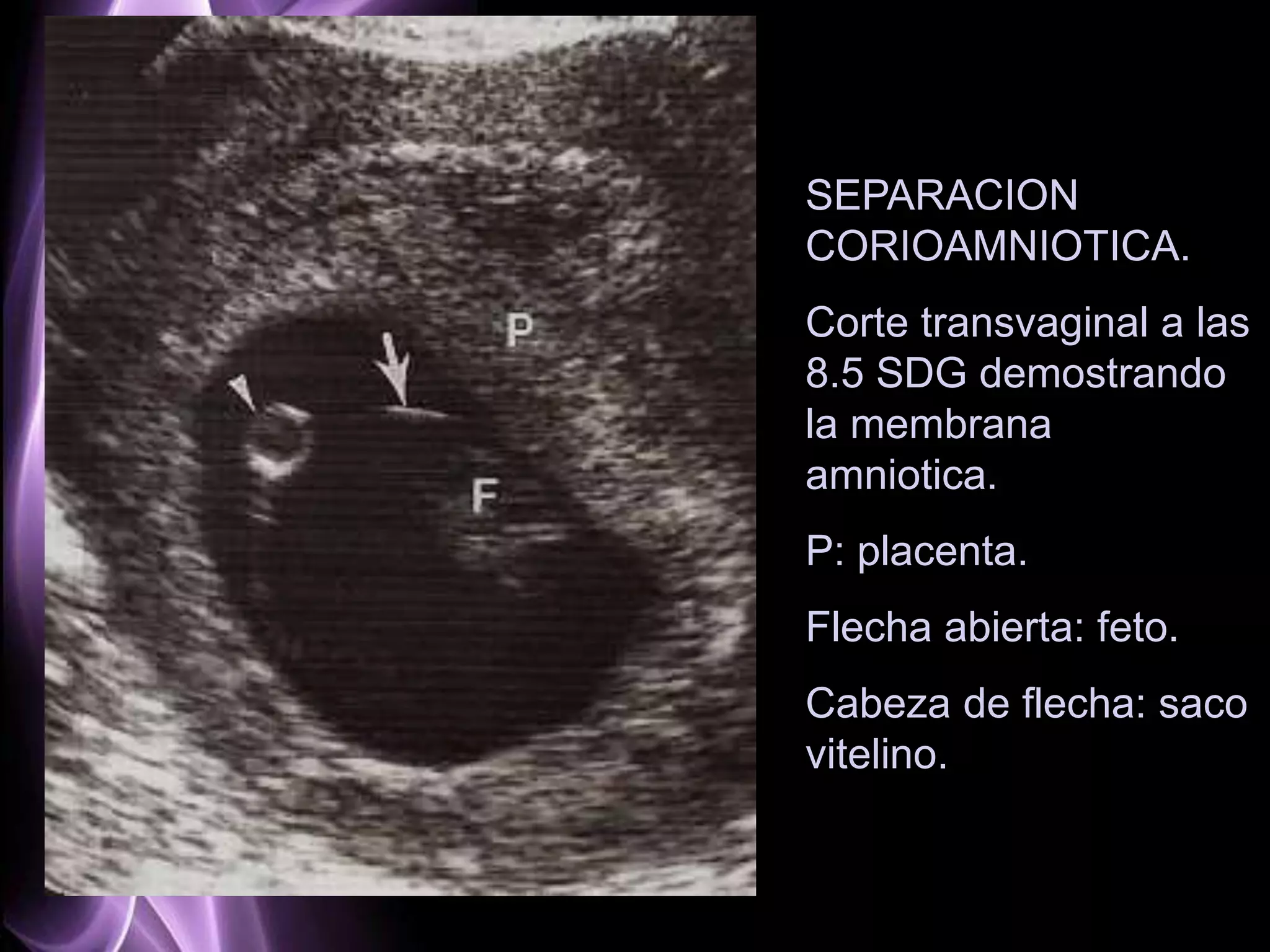 ECOGRAFÍA NORMAL Y PATOLOGÍA DE LA PLACENTA Y CORDÓN UMBILICAL | PPTX