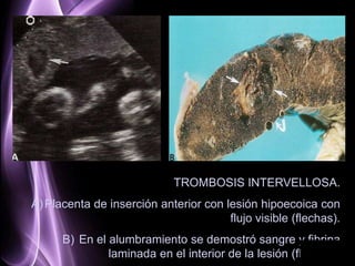 ECOGRAFÍA NORMAL Y PATOLOGÍA DE LA PLACENTA Y CORDÓN UMBILICAL | PPTX