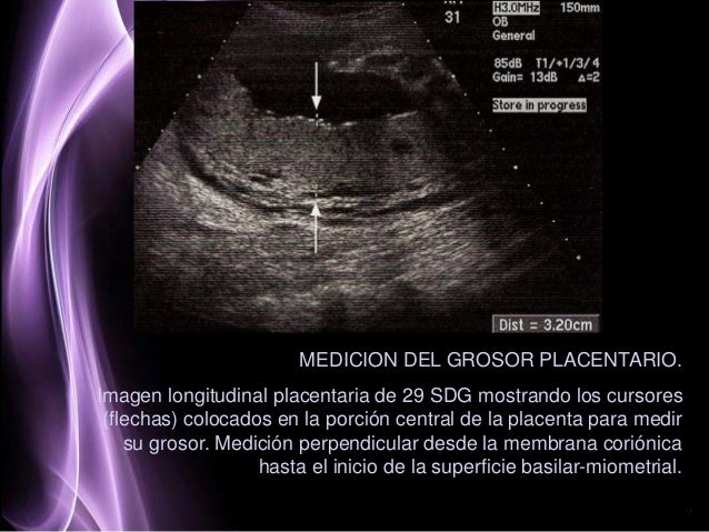 ECOGRAFÍA NORMAL Y PATOLOGÍA DE LA PLACENTA Y CORDÓN UMBILICAL