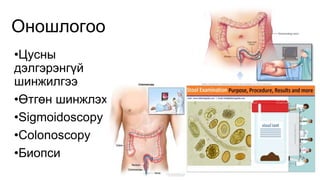 Paraproctitis тухай хийсэн ллллллллллллллллл | PPTX