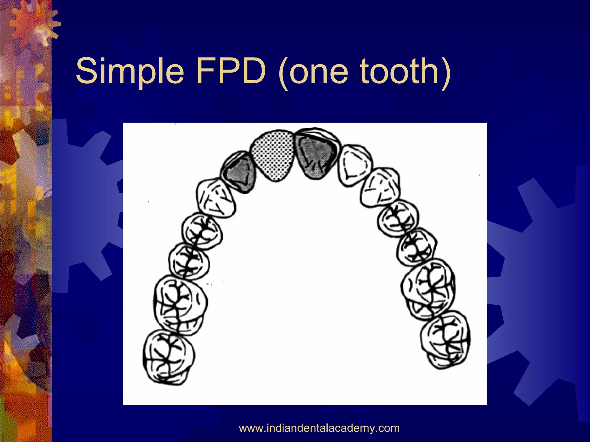 classification and configuration for fixed partial dentures/dental ...