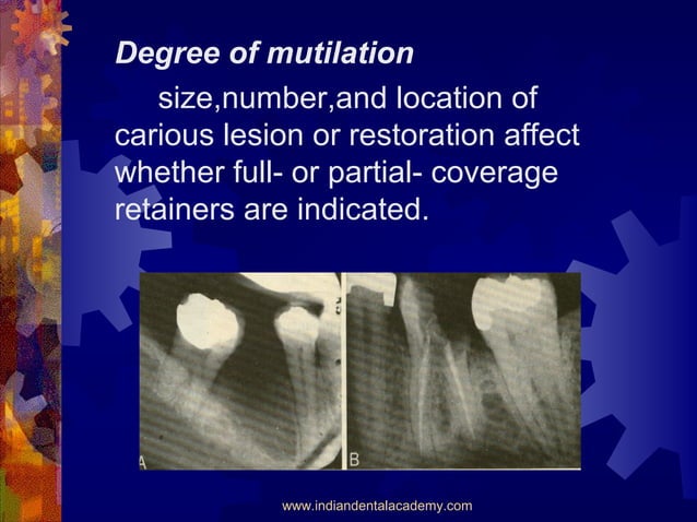 classification and configuration for fixed partial dentures/dental ...