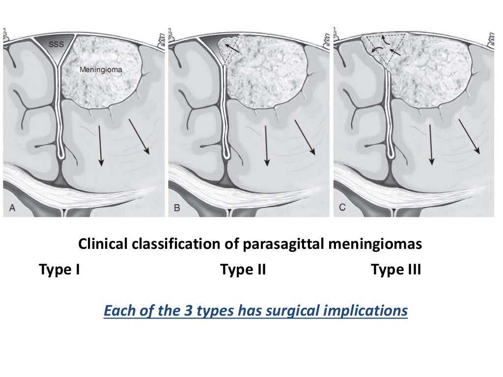 Parasagittal meningioma