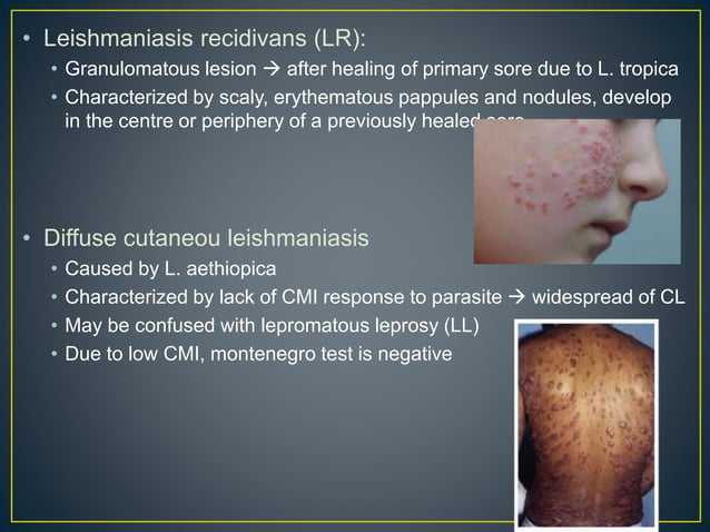Parasitic infection of Skin, Soft tissue and Muskuloskeletal tissues ...