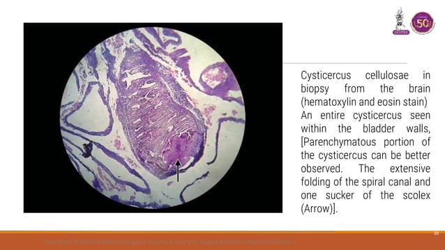 Parasitic Infections of CNS. Free living amoeba and ...
